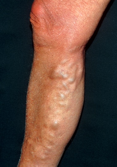 NHS 111 Wales Encyclopaedia Varicose Veins